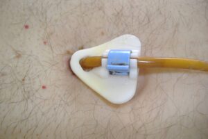 PEG Feeding | Peg Tube Insertion in Pune- Kaizen Gastro Care
