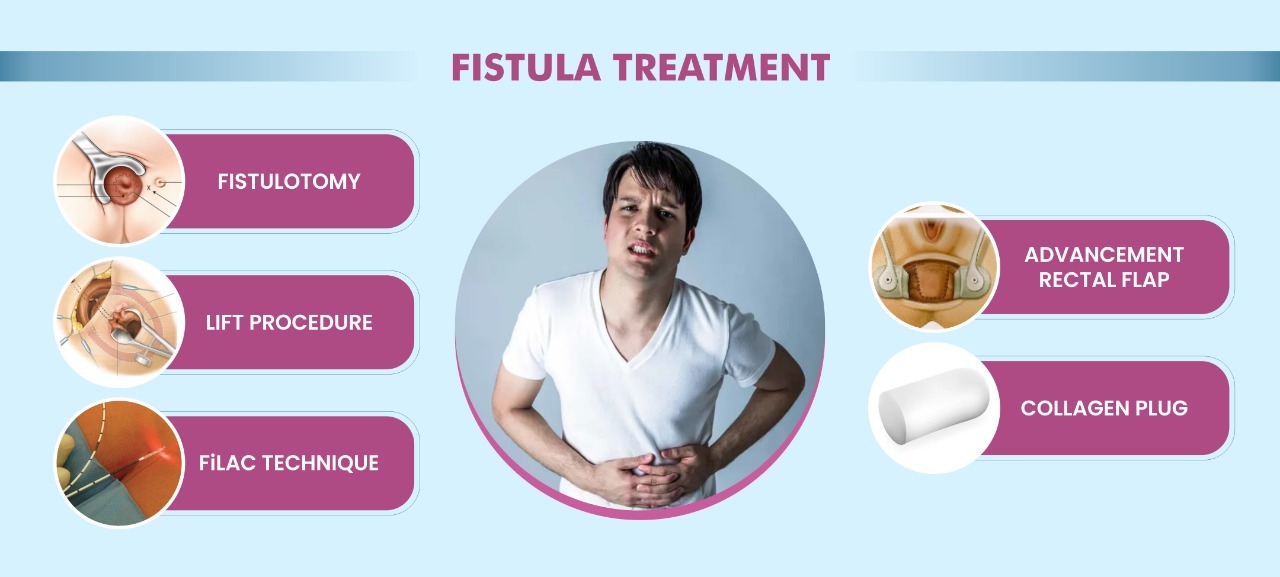 Fistula Specialist in Pune | Fistula treatment in Pune- Dr. Samrat Jankar