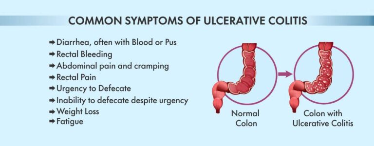 Ulcerative Colitis Treatment in Pune- Kaizen Gastro Care