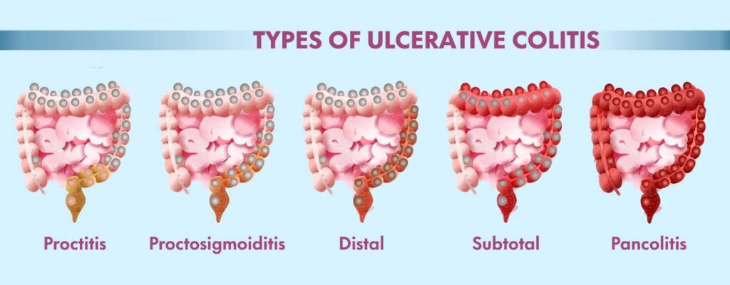 Ulcerative Colitis Treatment in Pune- Kaizen Gastro Care