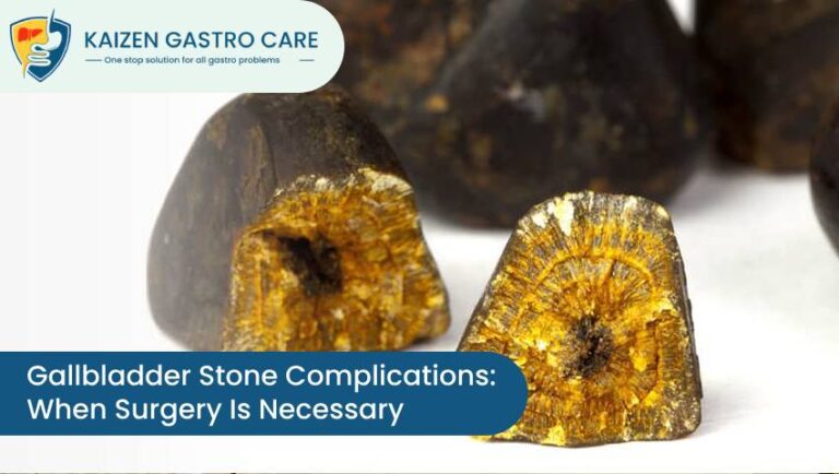 Gallbladder Stone Complications: When Surgery Is Necessary- Kaizen ...